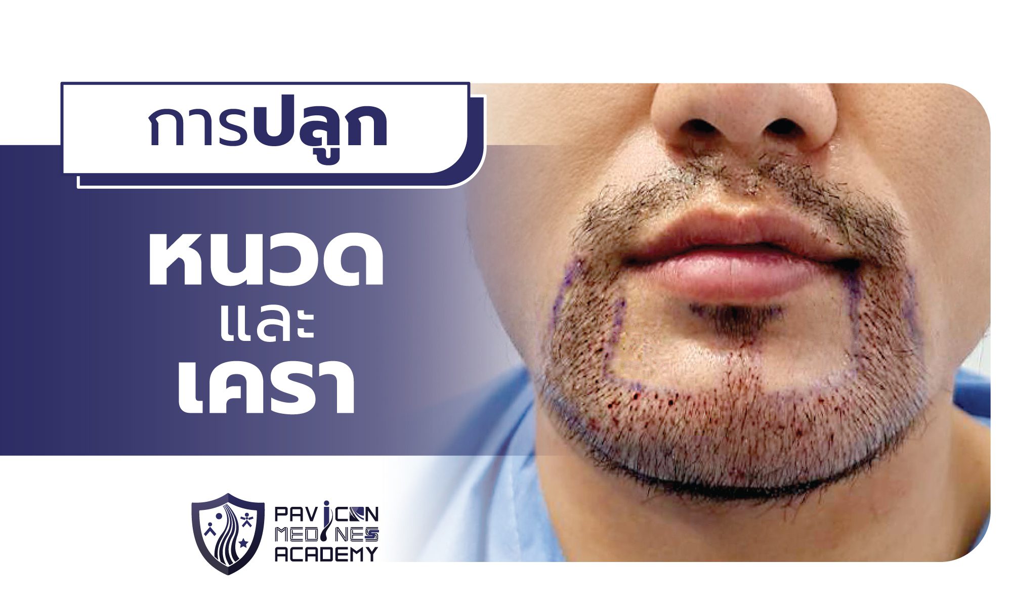 Beard Hair Transplant - Pavicon Mediness Center