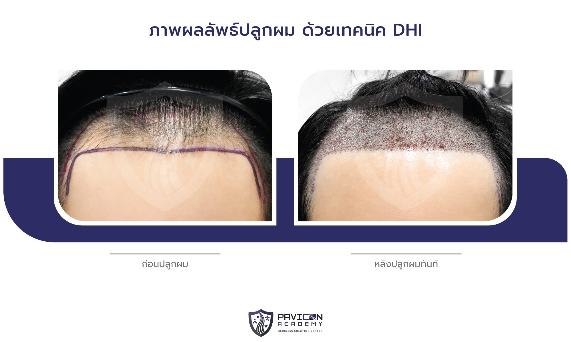 DHI Hair Transplant - Pavicon Mediness Center