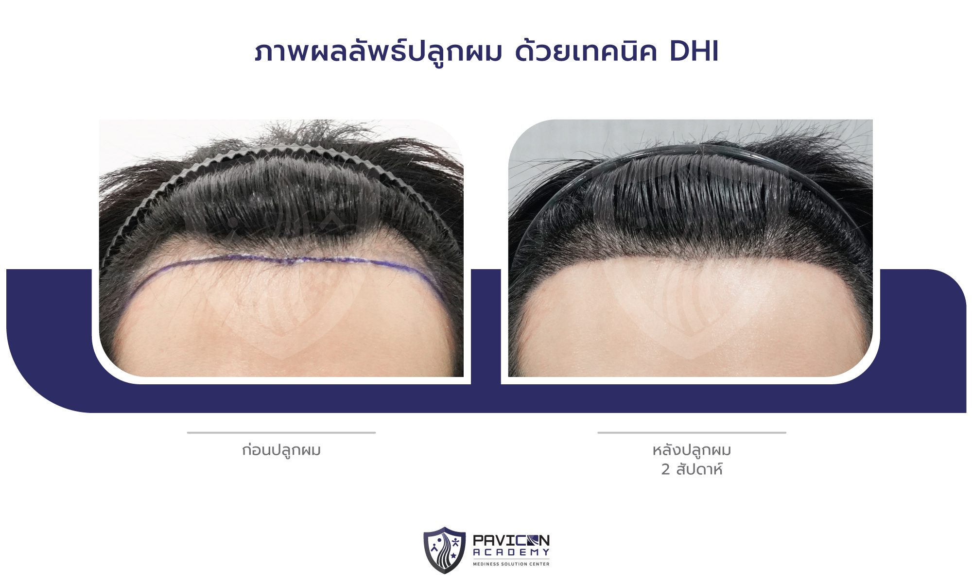 DHI Hair Transplant - Pavicon Mediness Center