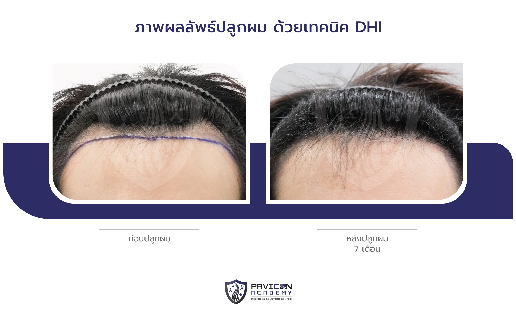 DHI Hair Transplant - Pavicon Mediness Center