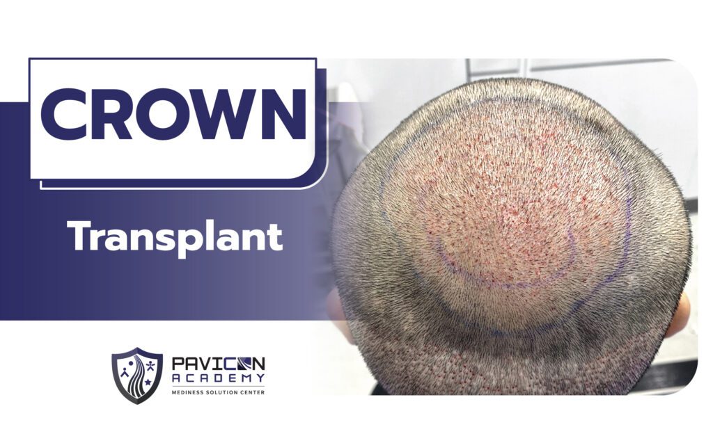 Crown Hair Transplant - Pavicon Mediness Center