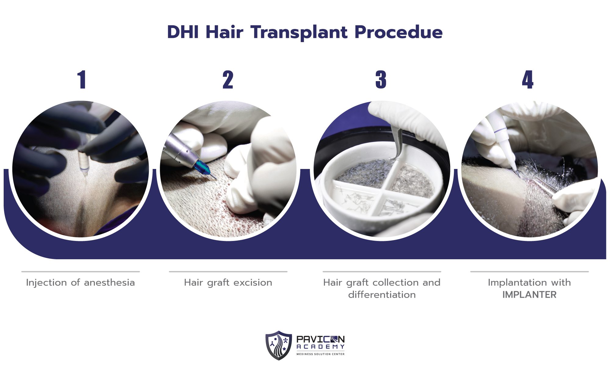 DHI Hair Transplant - Pavicon Mediness Center