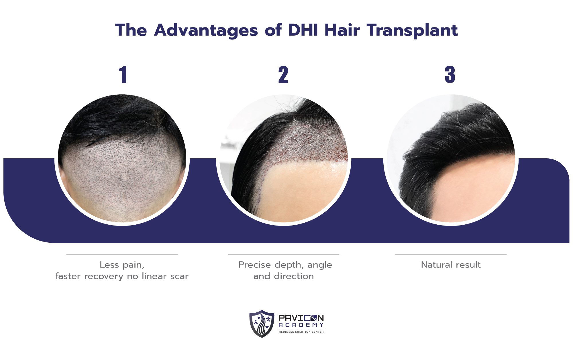 DHI Hair Transplant - Pavicon Mediness Center