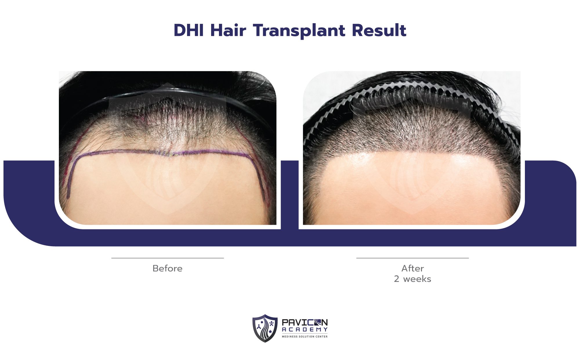 DHI Hair Transplant - Pavicon Mediness Center