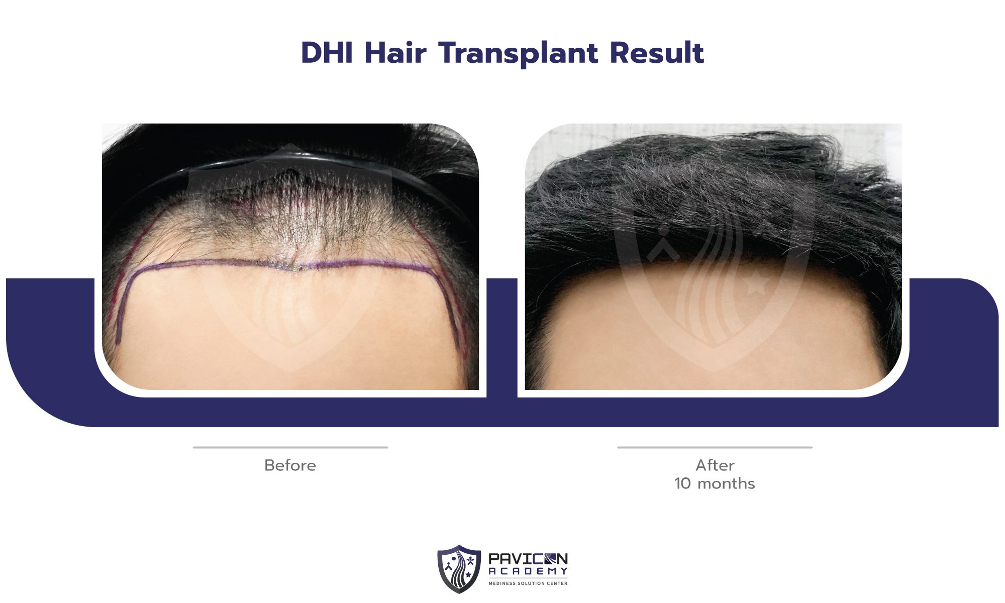 DHI Hair Transplant - Pavicon Mediness Center