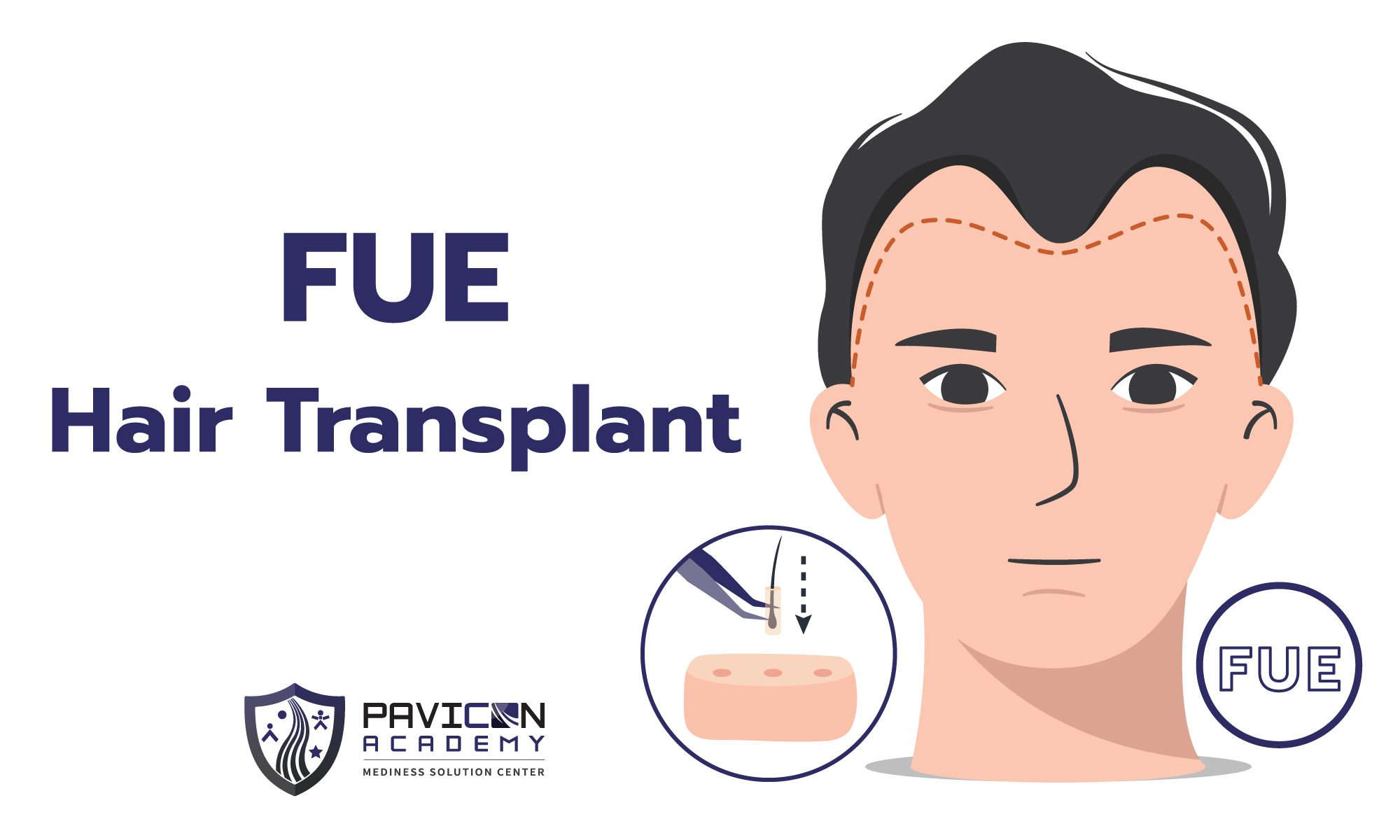 FUE Hair Transplant - Pavicon Mediness Center