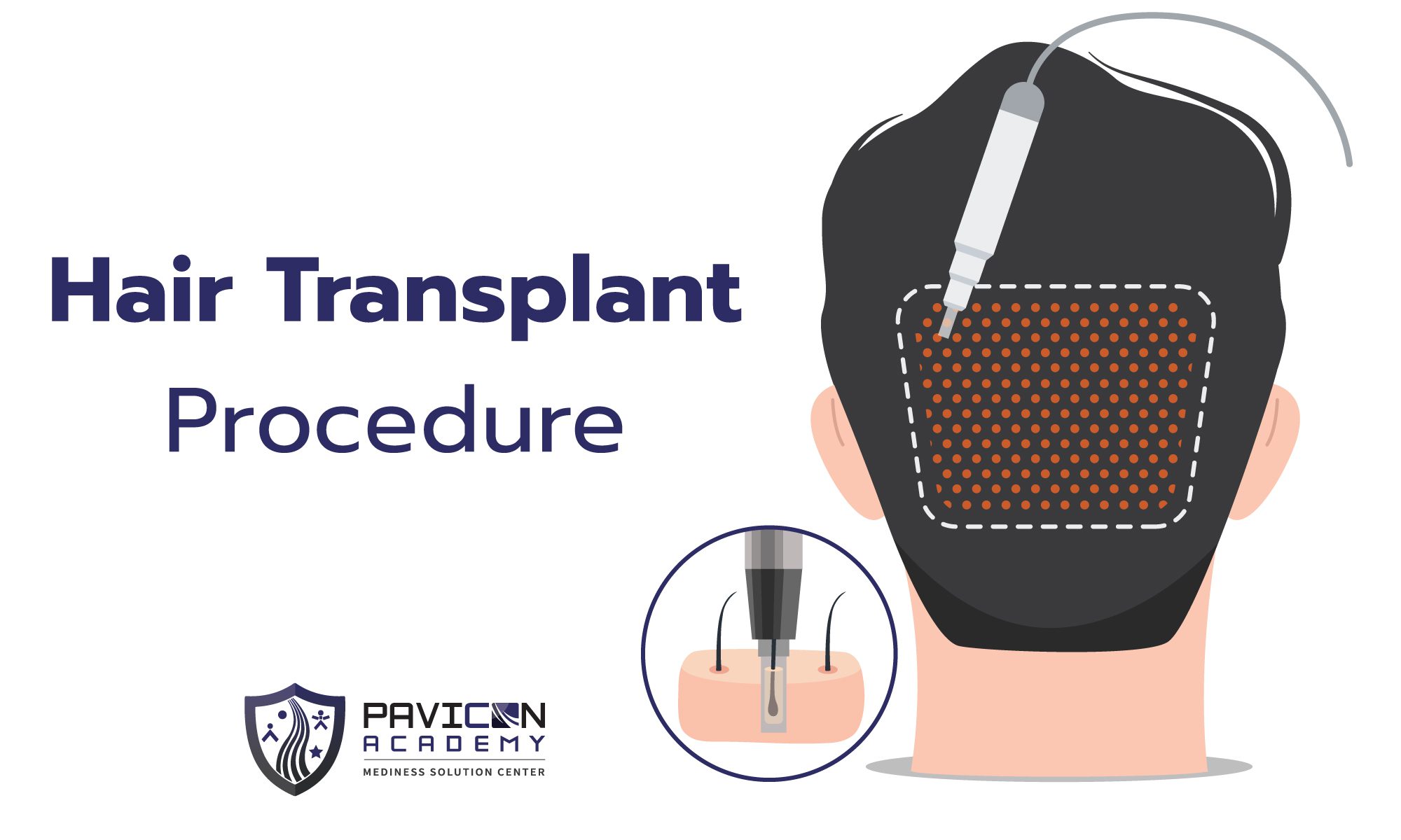 Hair Transplantation Procedure - Pavicon Mediness Center