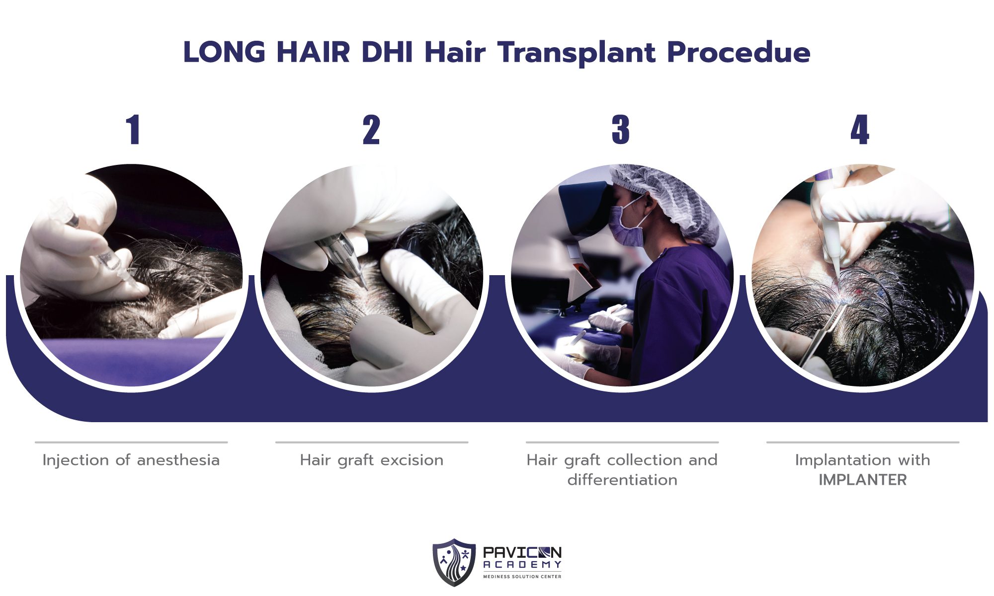Long Hair DHI - Pavicon Mediness Center