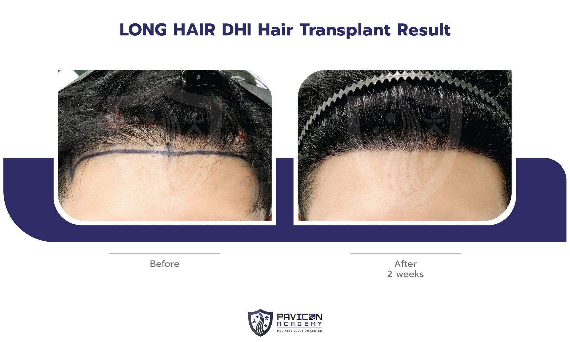 Long Hair DHI - Pavicon Mediness Center
