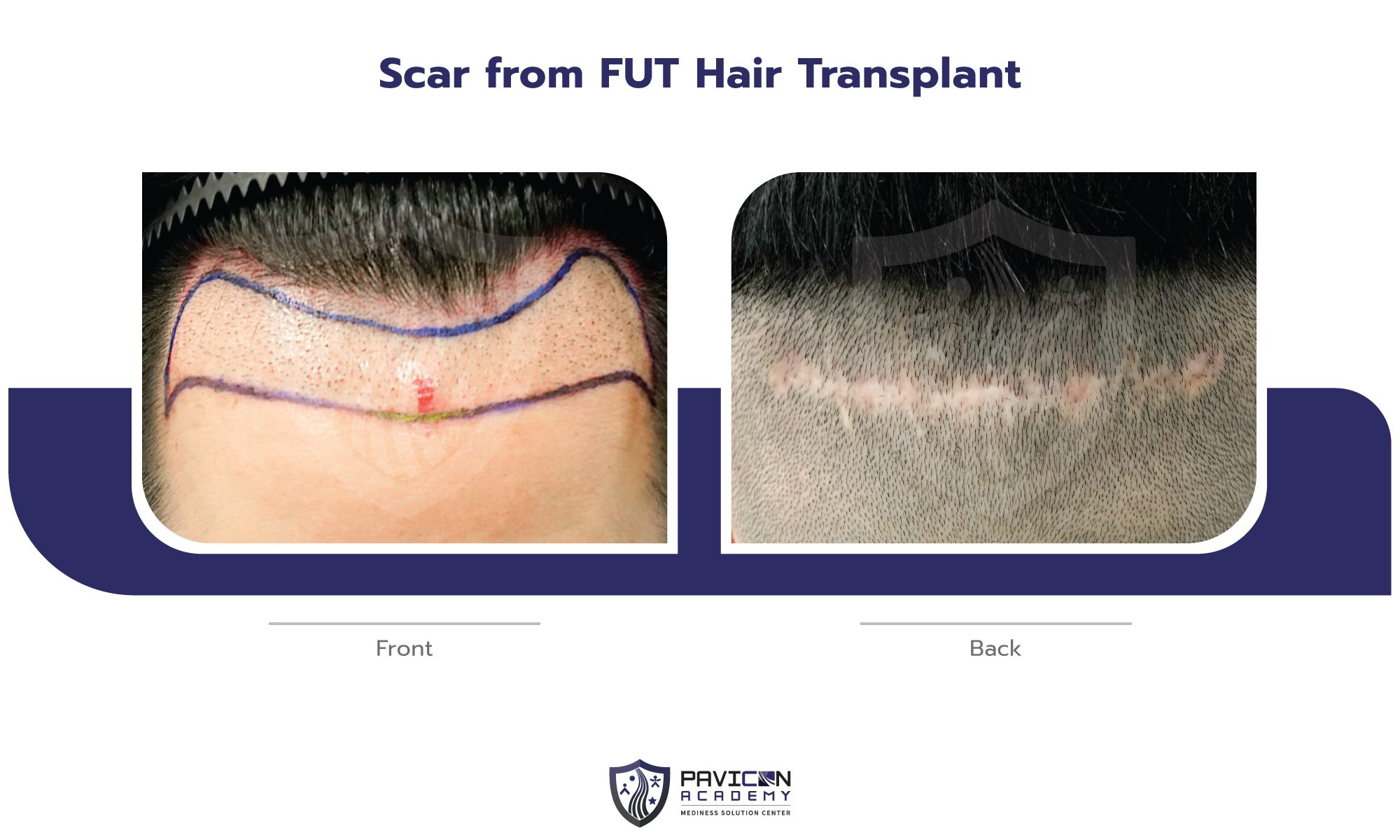 Scar Hair Transplant - Pavicon Mediness Center