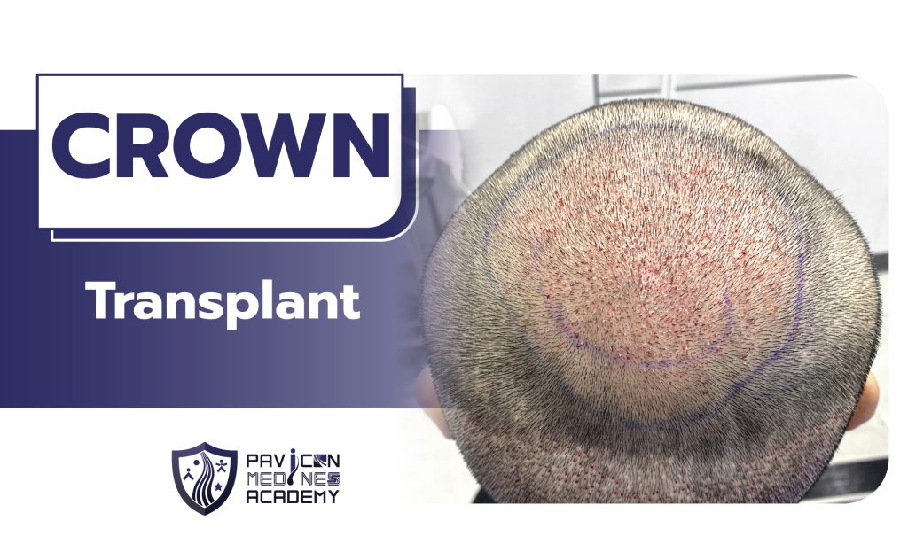 Crown Hair Transplant - Pavicon Mediness Center