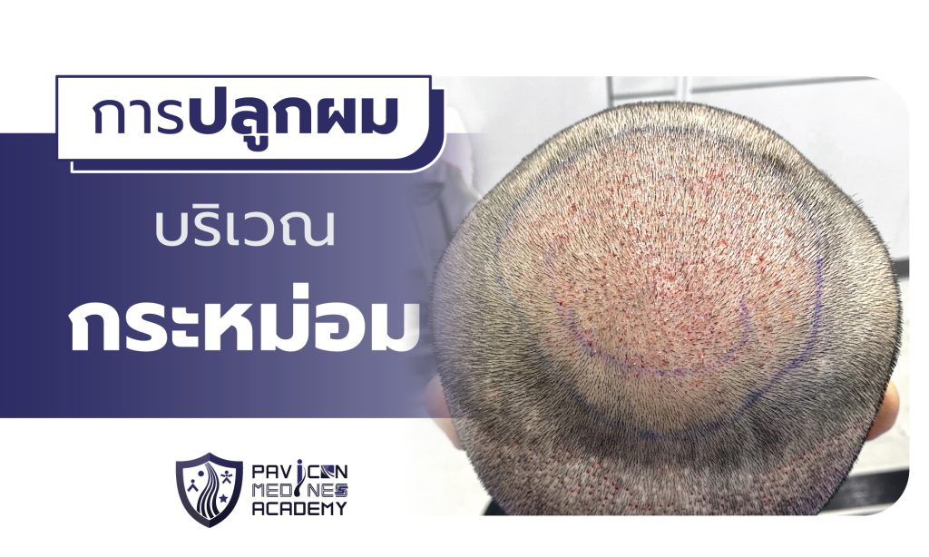 Crown Hair Transplant - Pavicon Mediness Center