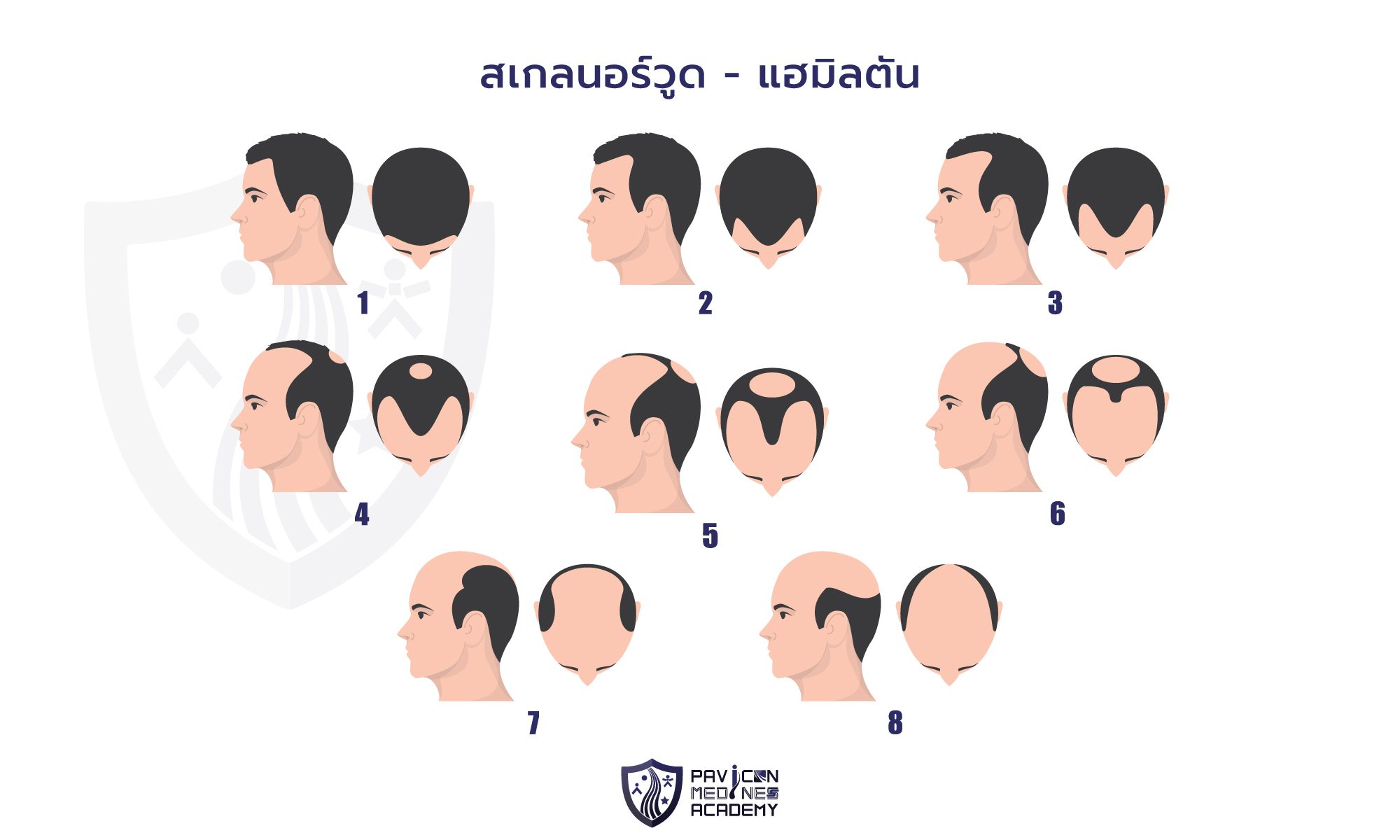 Crown Hair Transplant - Pavicon Mediness Center