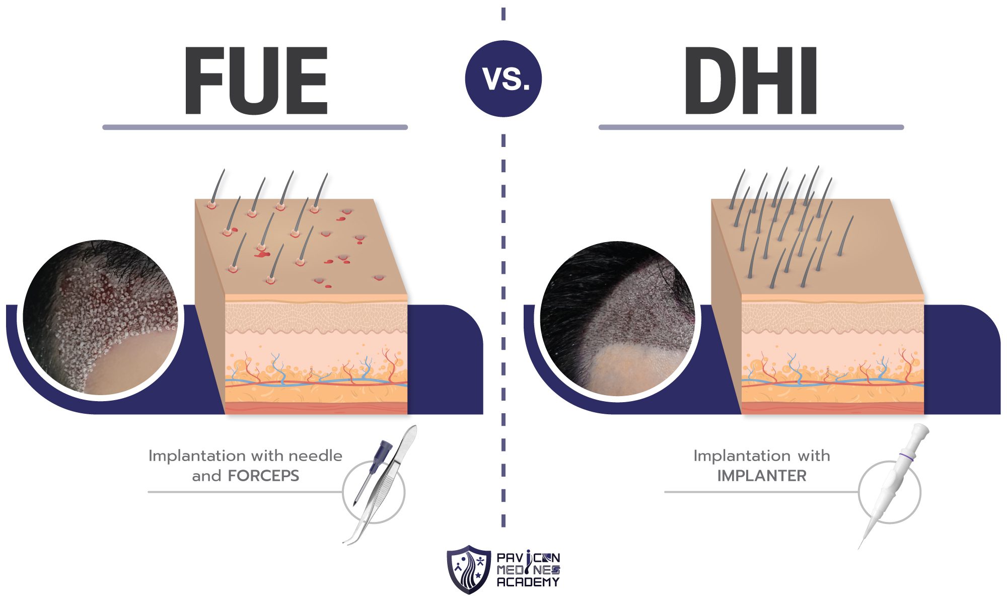 DHI Hair Transplant - Pavicon Mediness Center