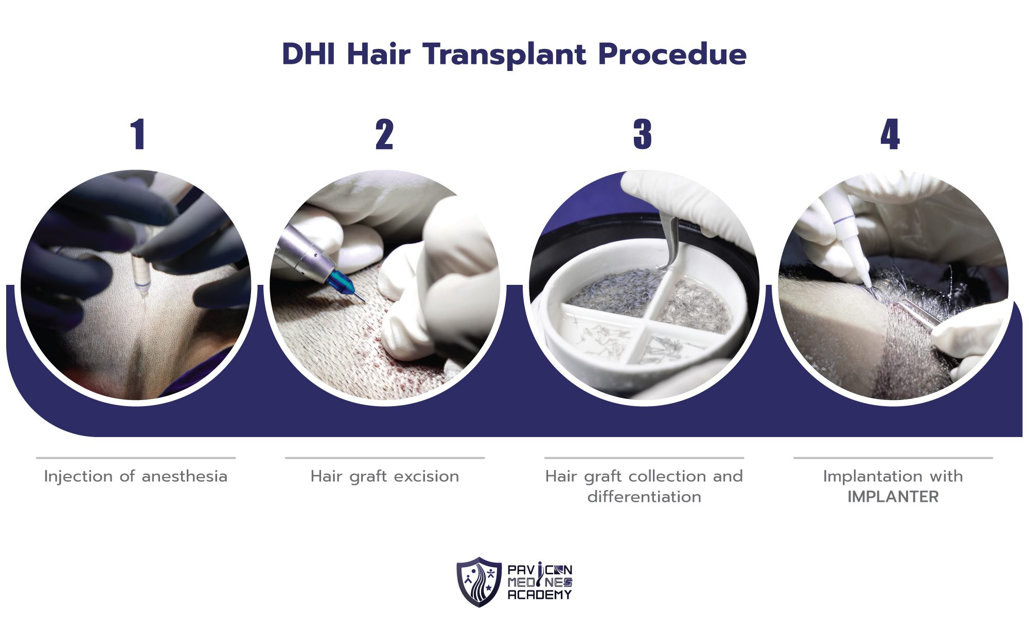 DHI Hair Transplant - Pavicon Mediness Center