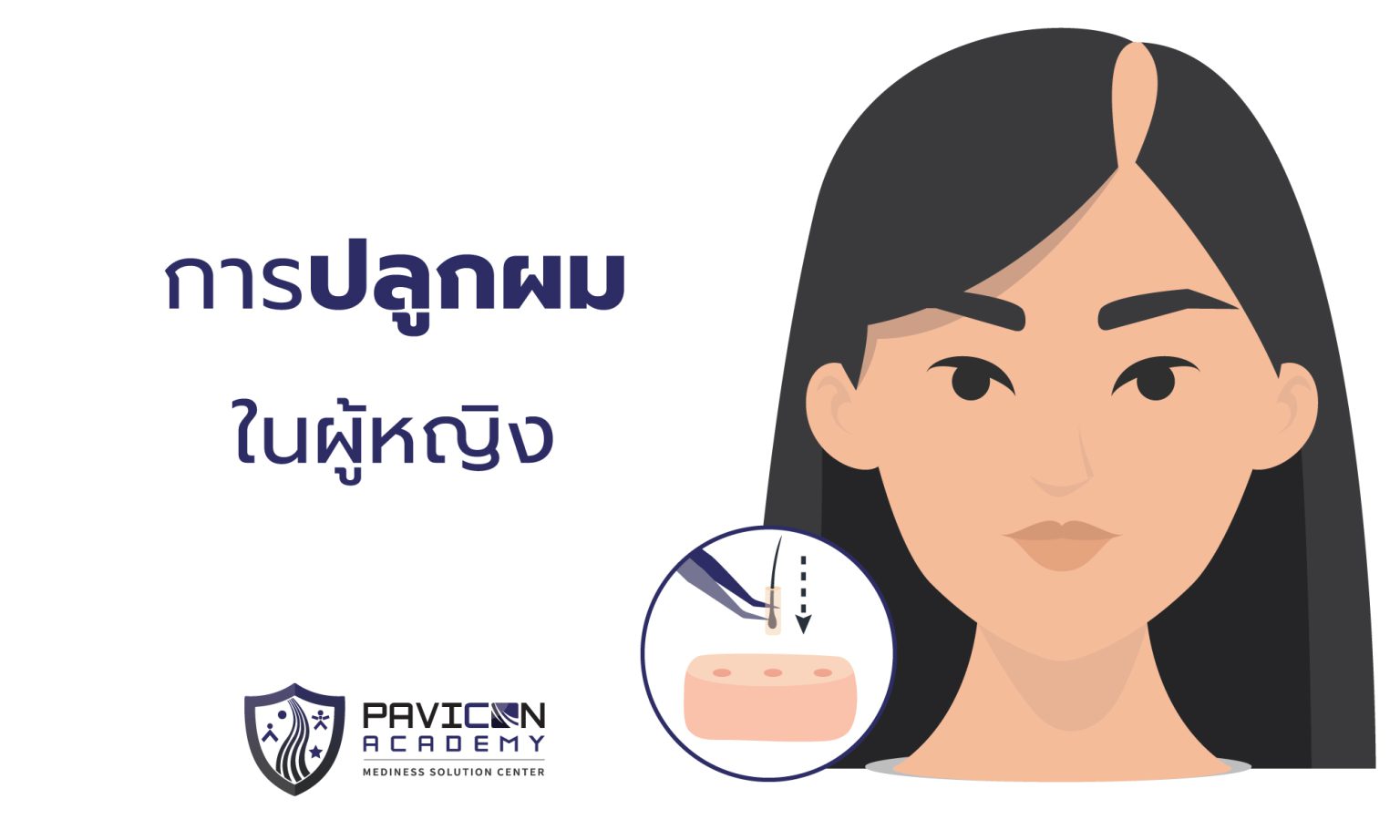 Woman Hair Transplant - Pavicon Mediness Center
