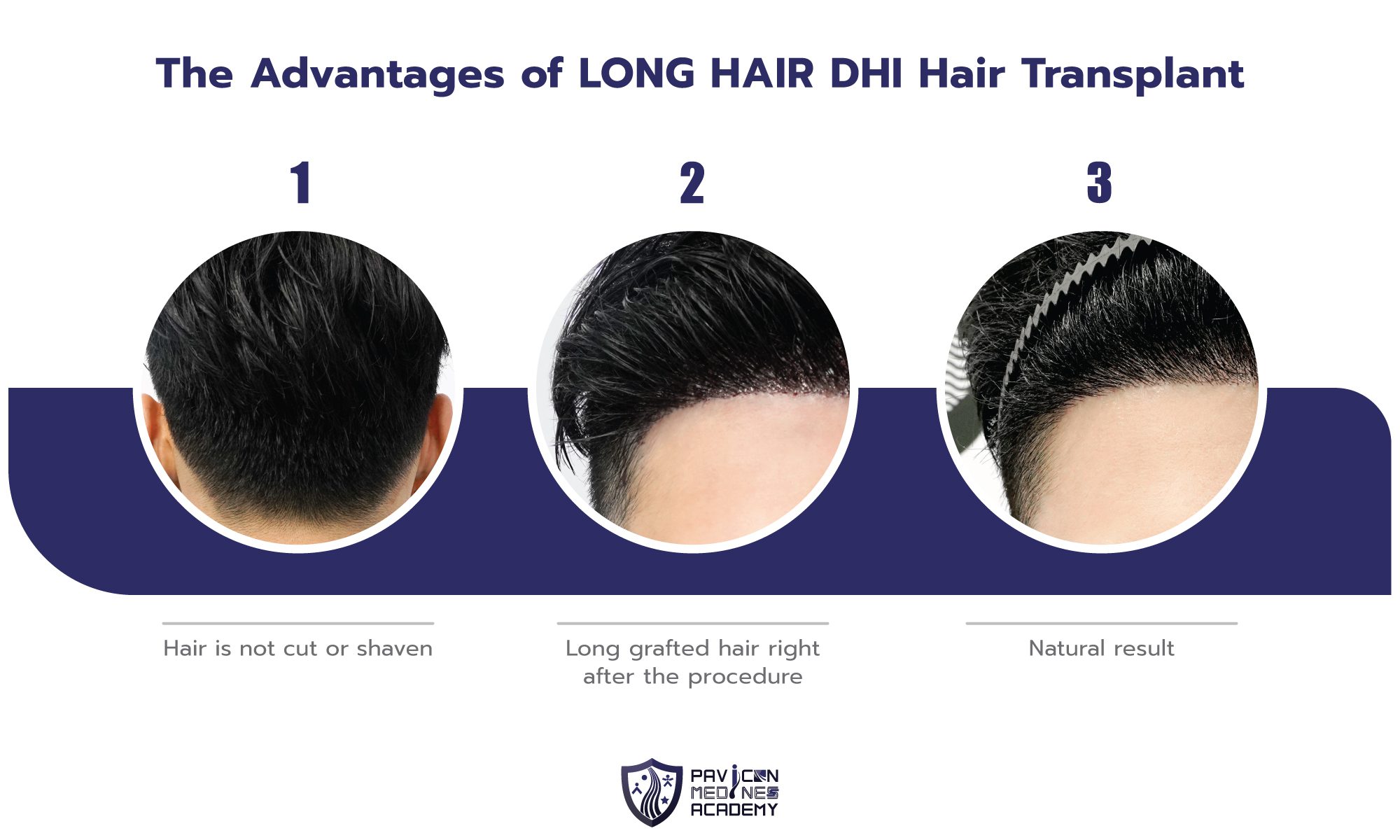 Long Hair DHI - Pavicon Mediness Center