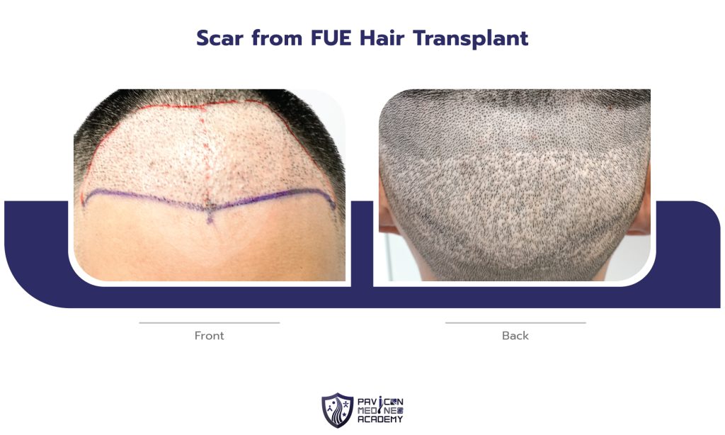 Scar Hair Transplant - Pavicon Mediness Center