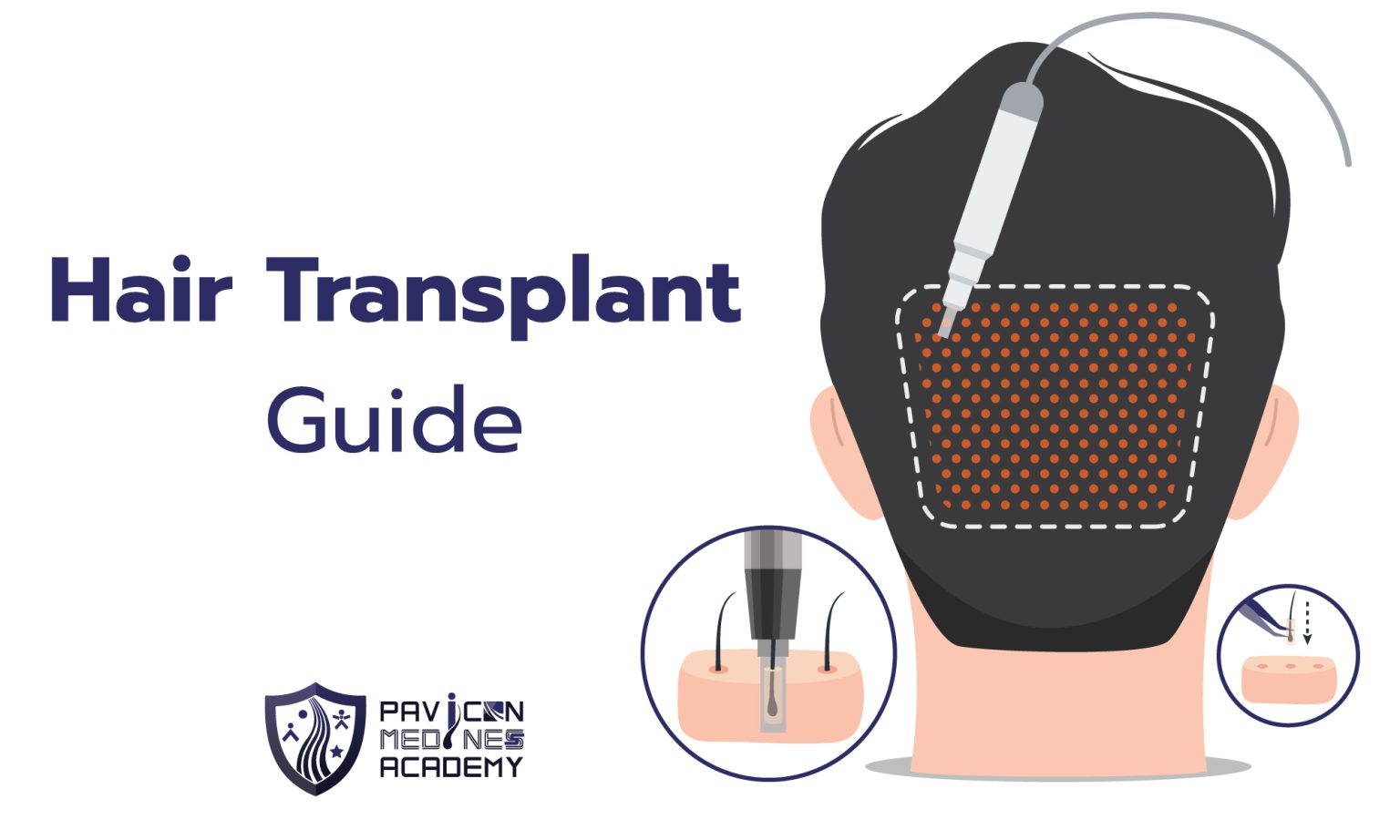 Hair Transplant Guide - Pavicon Mediness Center